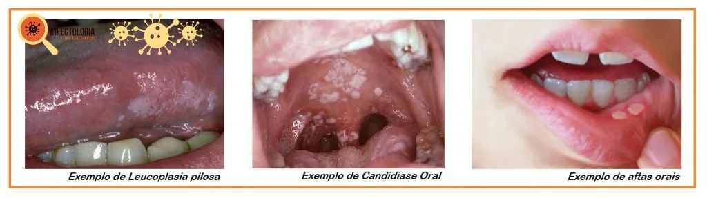 Lesoes De Hiv No Pescoco OncoExperts Notícias Câncer De Cabeça