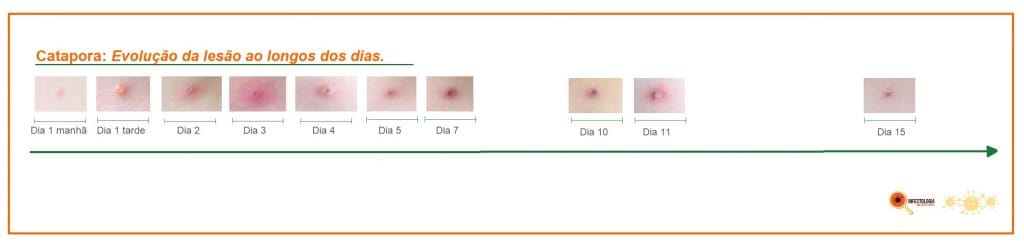 Catapora: Saiba mais | Dra. Keilla Freitas - Dra keilla Freitas