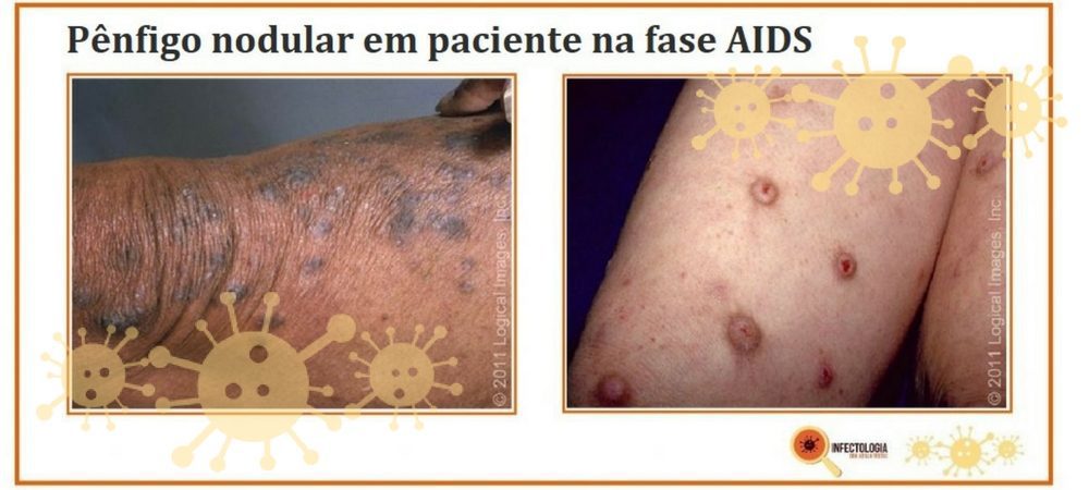 Sintomas Do Virus Hiv Aids Sintomas De HIV Na Boca: 5 Sinais E Como