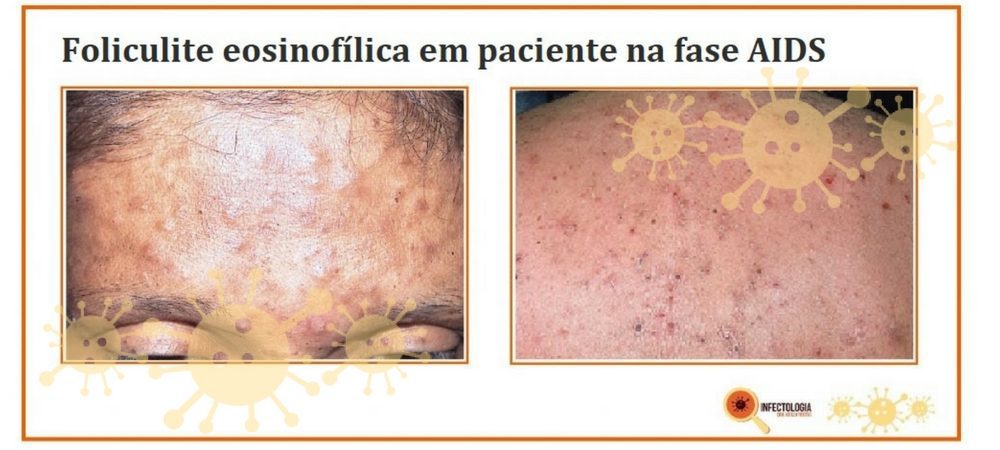 Sintomas da AIDS | Dra. Keilla Freitas - Dra keilla Freitas