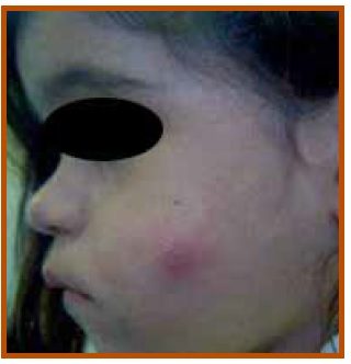 Leishmaniose Cutânea - Dra keilla Freitas