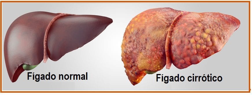 Cirrose hepática é a fase irreversível da lesão hepática. - Dra keilla ...