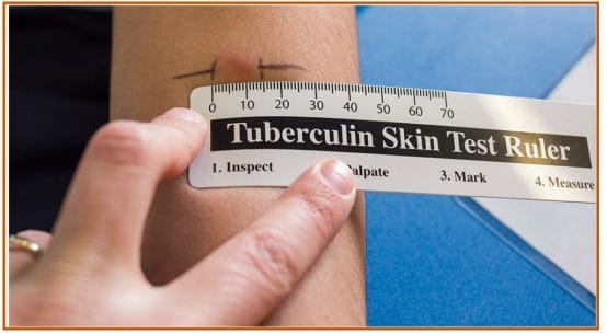 diagnóstico da tuberculose