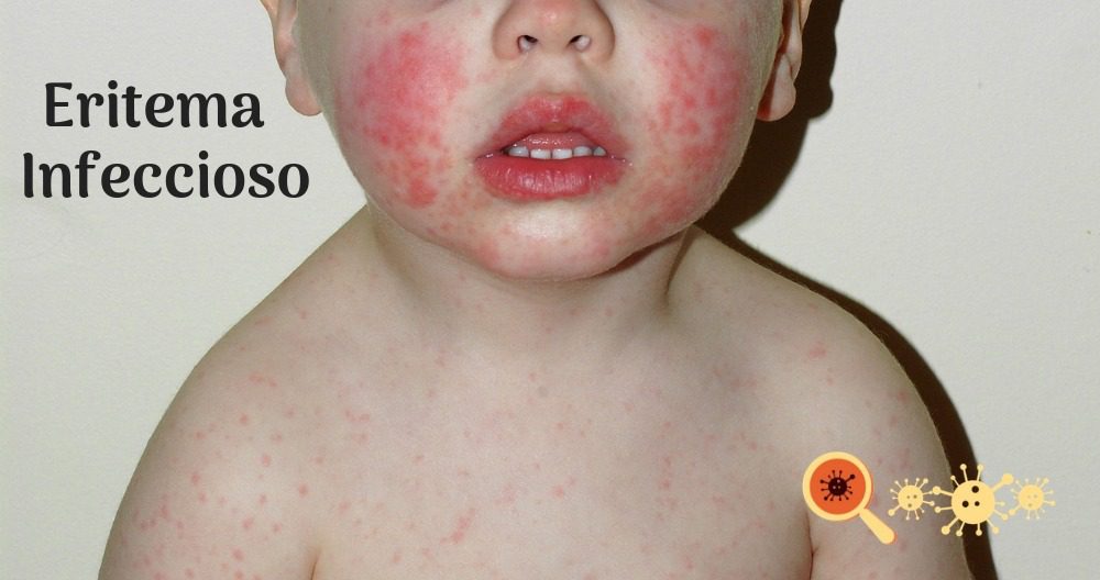 Eritema Infeccioso parvovirus B 19 - Dra keilla Freitas